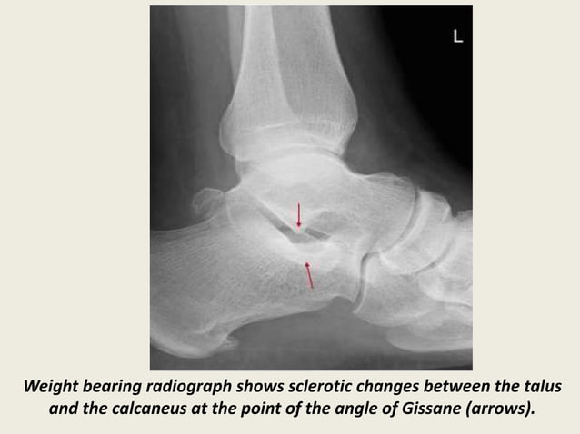 Extra-Articular Lateral Hindfoot Impingement Syndrome – FBQA