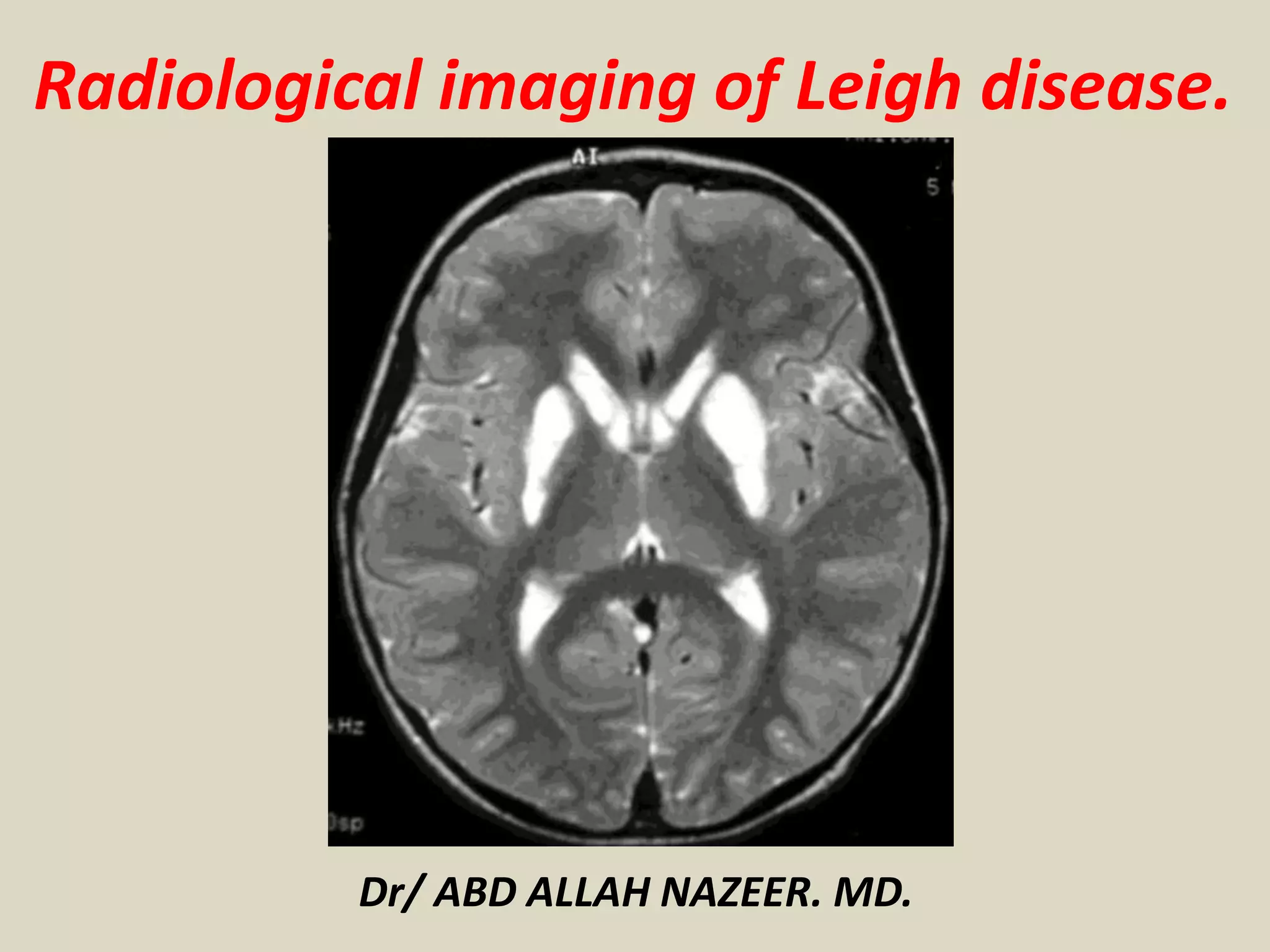Presentation1, radiological imaging of leigh disease. | PPTX