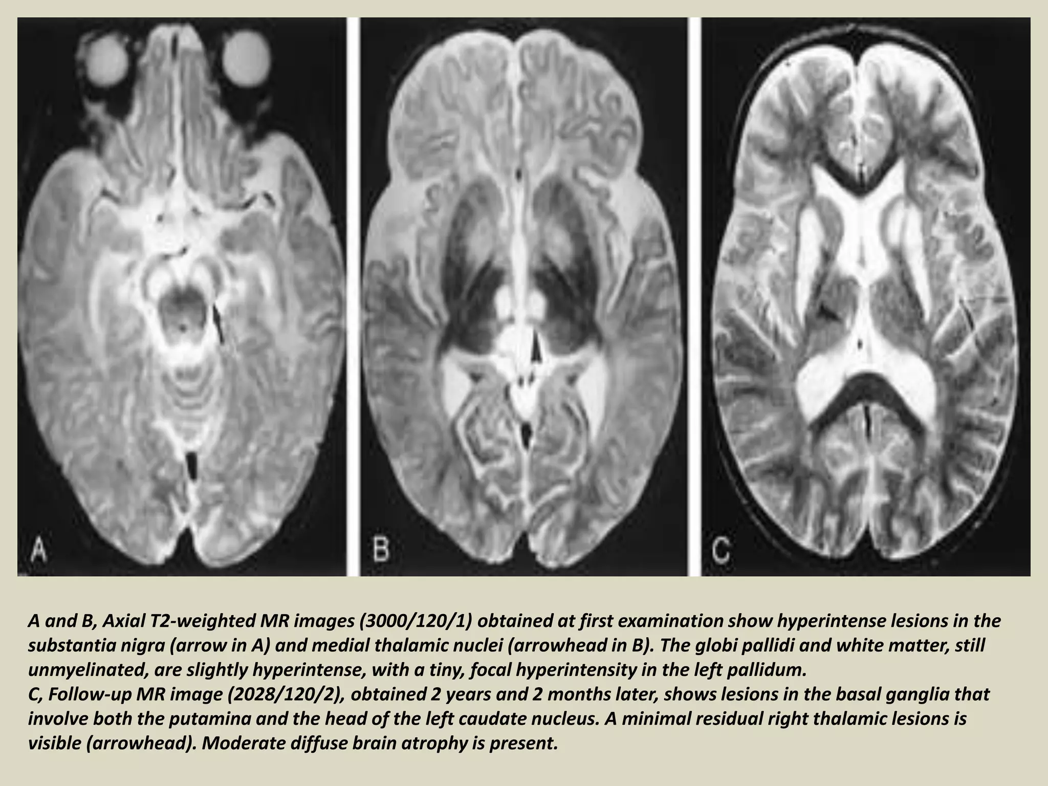 Presentation1, radiological imaging of leigh disease. | PPTX