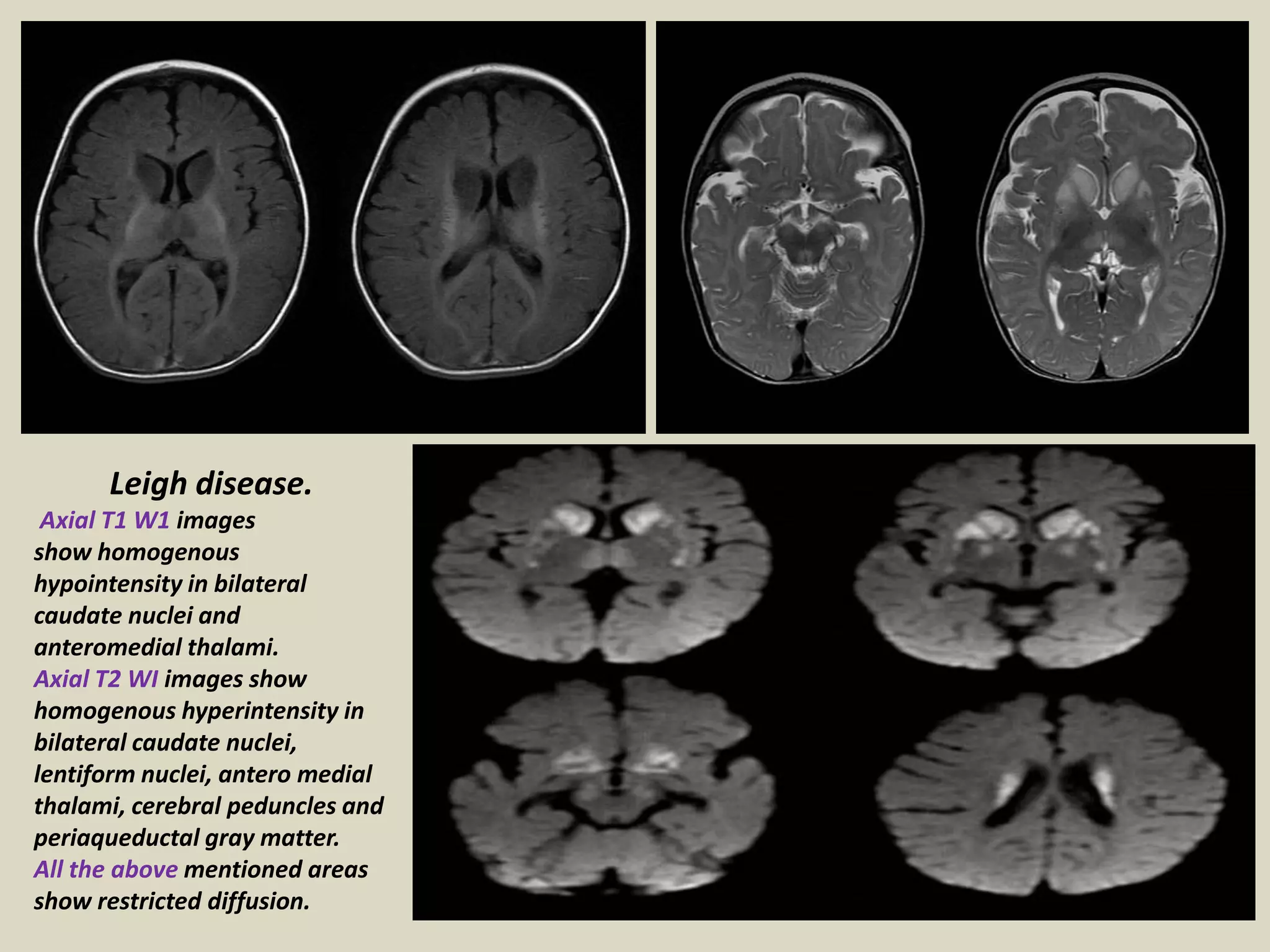 Presentation1, radiological imaging of leigh disease. | PPTX