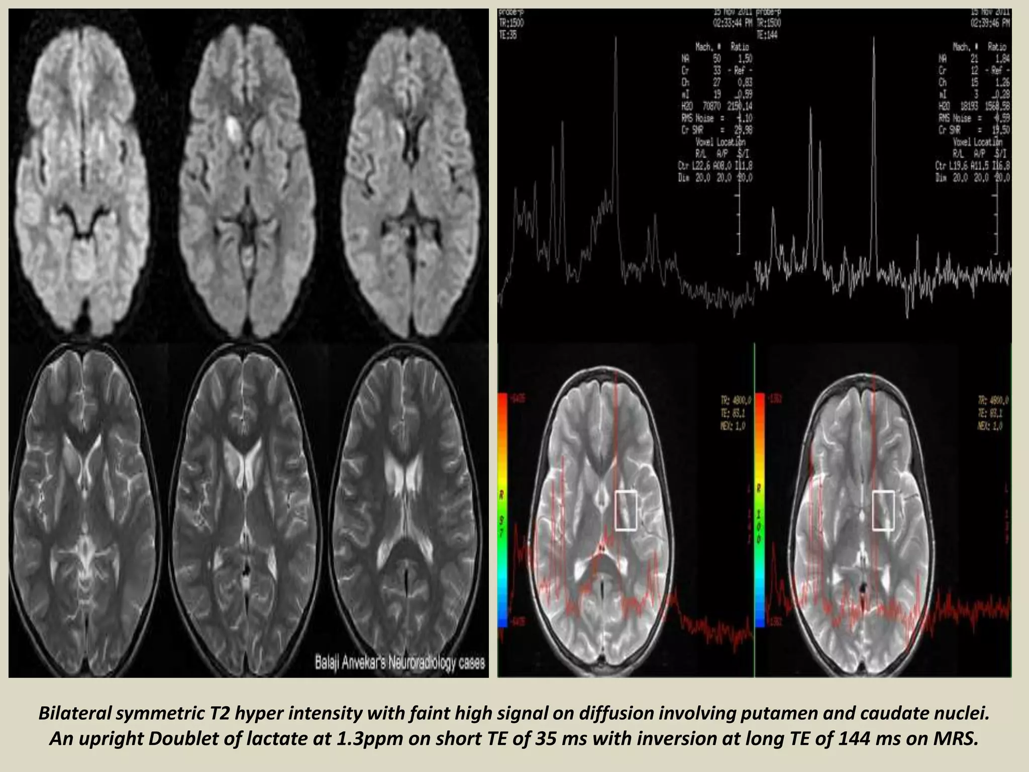 Presentation1, radiological imaging of leigh disease. | PPTX