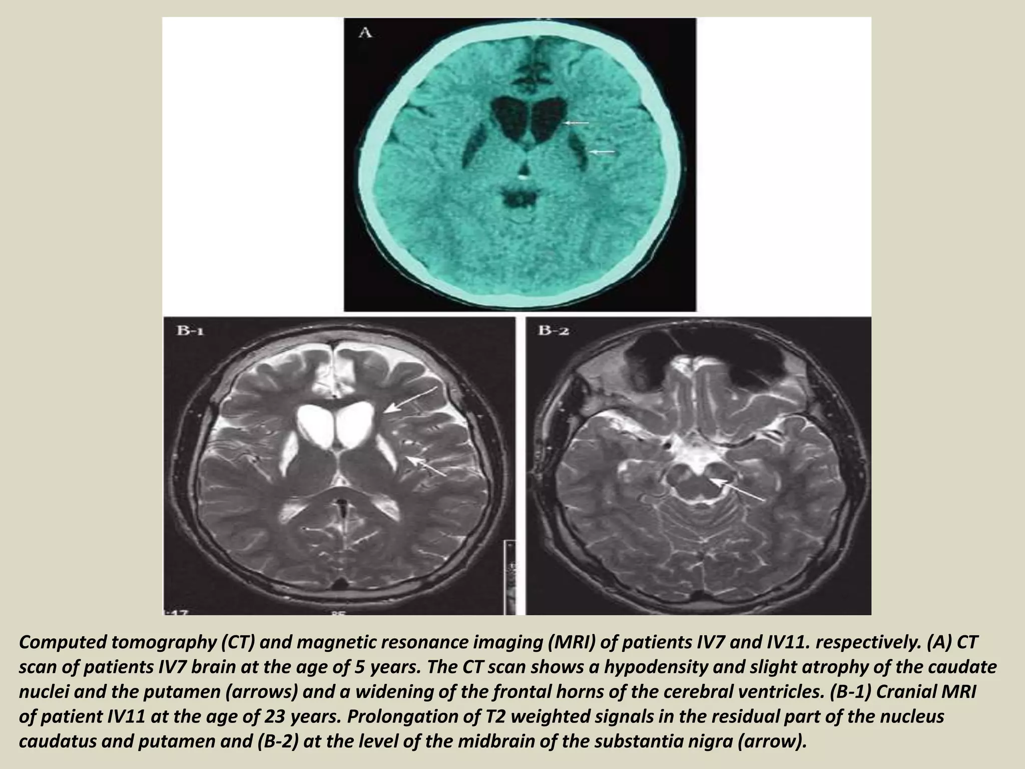 Presentation1, radiological imaging of leigh disease. | PPTX