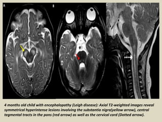 Presentation1, radiological imaging of leigh disease. | PPTX