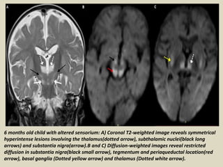 Presentation1, radiological imaging of leigh disease. | PPTX