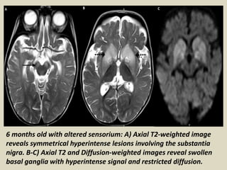 Presentation1, radiological imaging of leigh disease. | PPTX