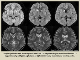 Presentation1, radiological imaging of leigh disease. | PPTX