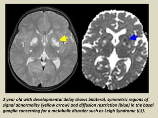 Presentation1, radiological imaging of leigh disease. | PPTX