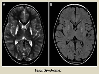 Presentation1, radiological imaging of leigh disease. | PPTX
