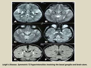 Presentation1, radiological imaging of leigh disease. | PPTX