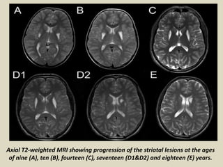 Presentation1, radiological imaging of leigh disease. | PPTX