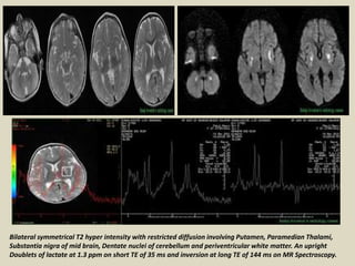 Presentation1, radiological imaging of leigh disease. | PPTX