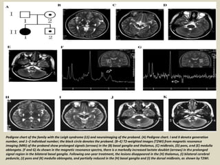 Presentation1, radiological imaging of leigh disease. | PPTX