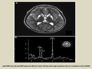 Presentation1, radiological imaging of leigh disease. | PPTX