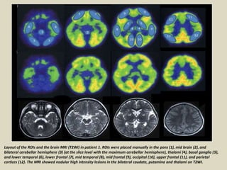 Presentation1, radiological imaging of leigh disease. | PPTX
