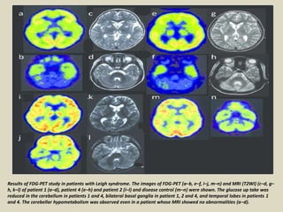 Presentation1, radiological imaging of leigh disease. | PPTX