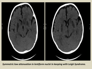 Presentation1, radiological imaging of leigh disease. | PPTX