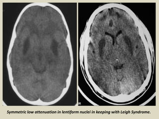 Presentation1, radiological imaging of leigh disease. | PPTX