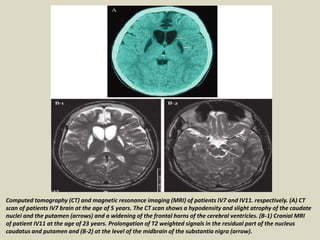 Presentation1, radiological imaging of leigh disease. | PPTX