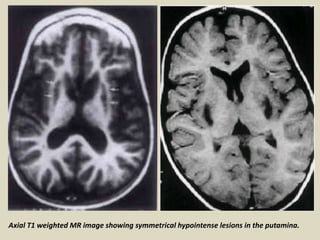 Presentation1, radiological imaging of leigh disease. | PPTX