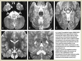 Presentation1, radiological imaging of leigh disease. | PPTX
