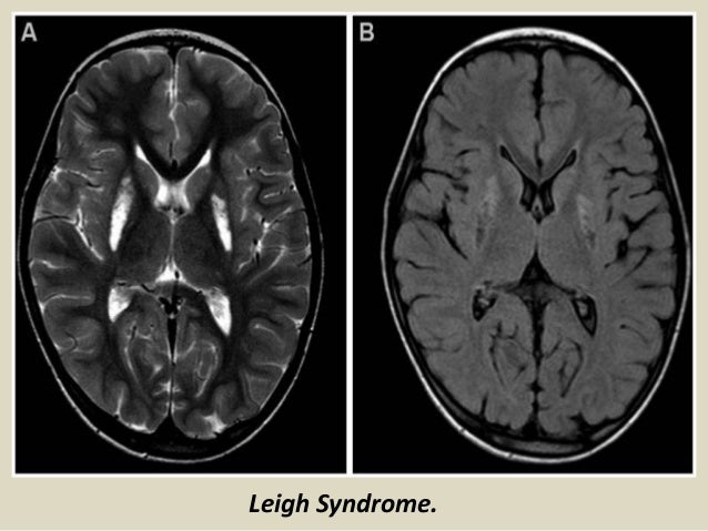 Presentation1, radiological imaging of leigh disease.