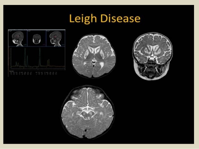 Presentation1, radiological imaging of leigh disease.