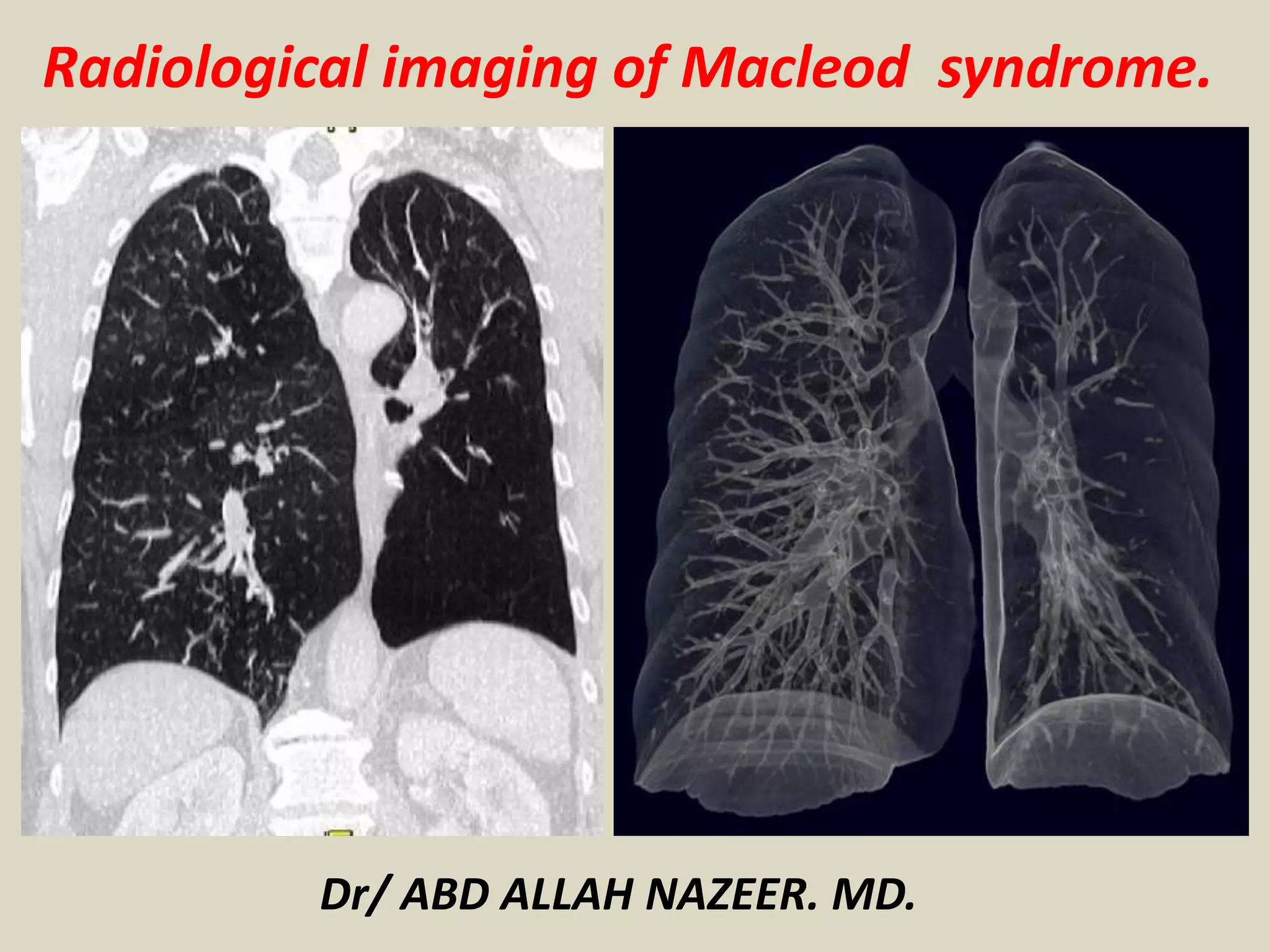 Presentation1, radiological imaging of macleod syndrome. | PPTX