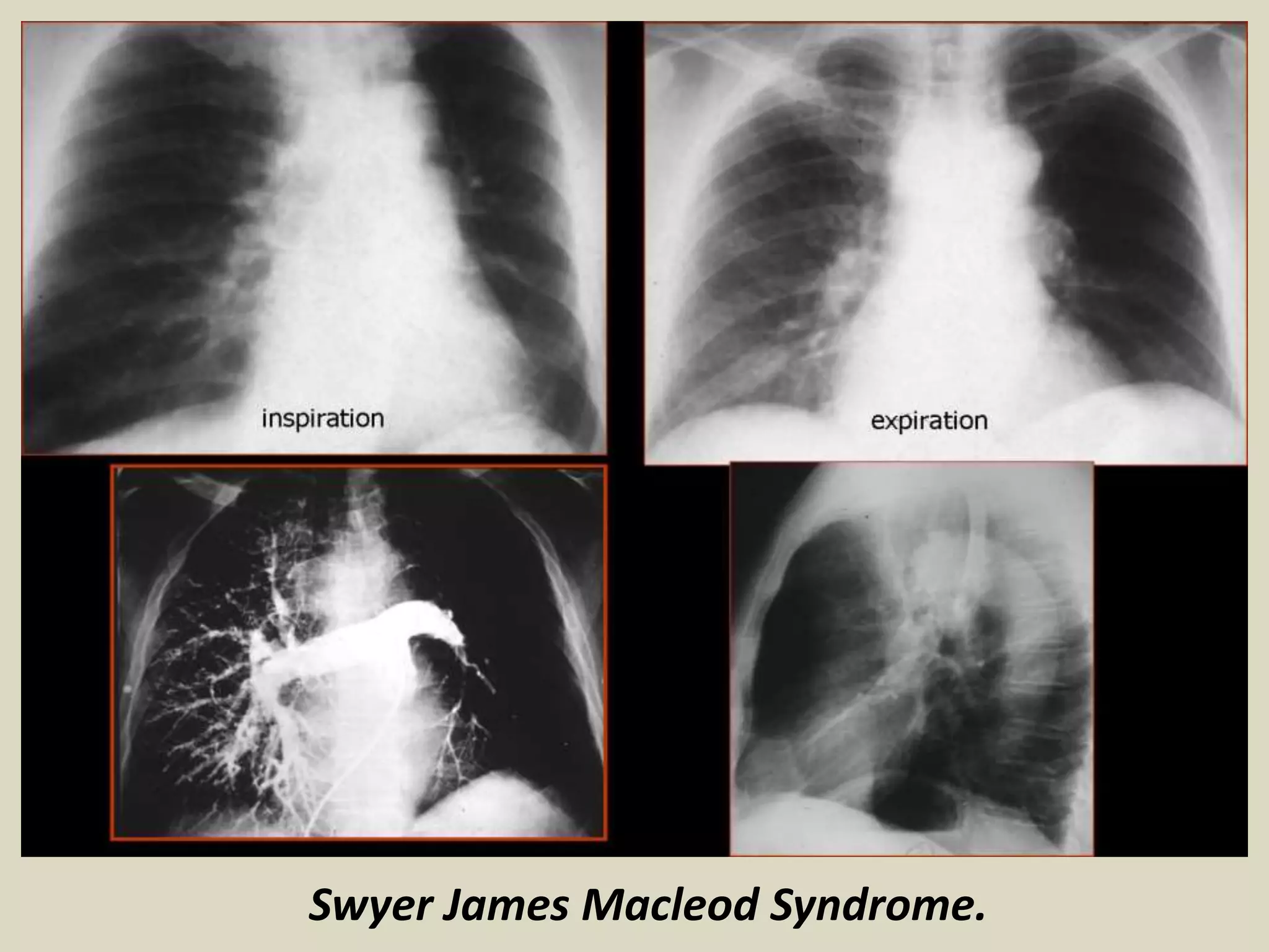 Presentation1, radiological imaging of macleod syndrome. | PPTX