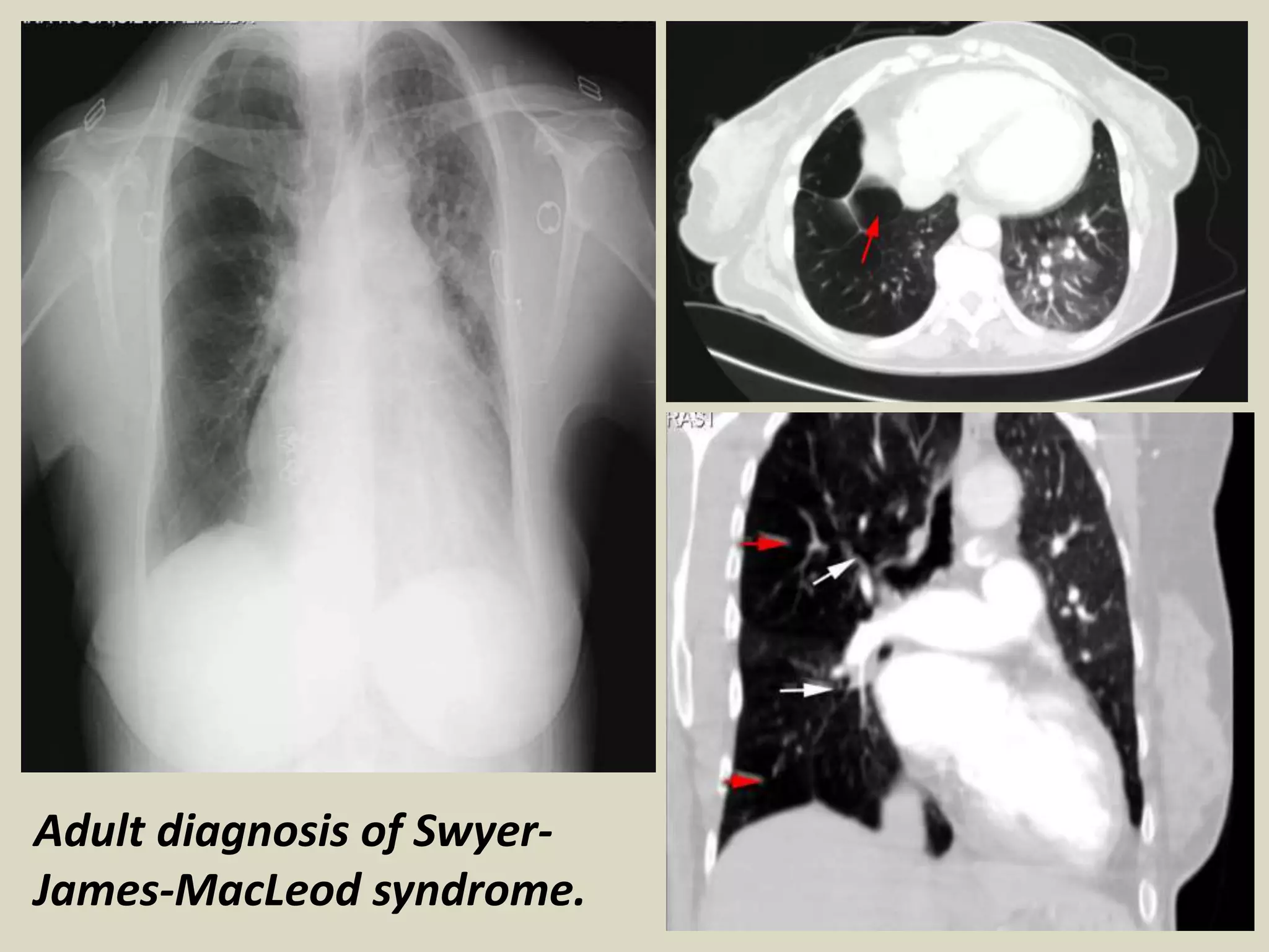 Presentation1, radiological imaging of macleod syndrome. | PPTX