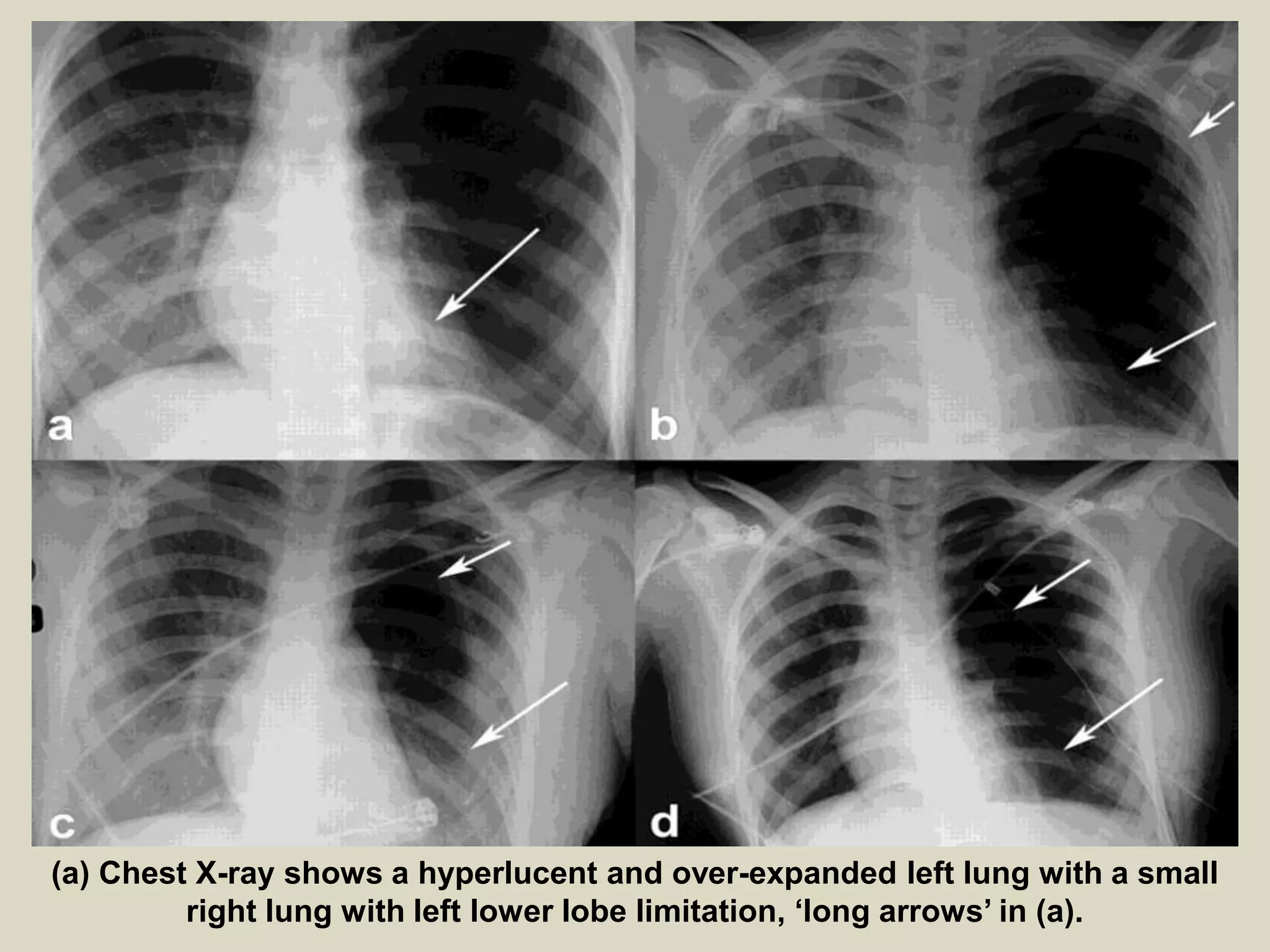 Presentation1, radiological imaging of macleod syndrome. | PPTX