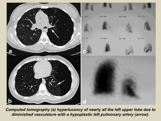 Presentation1, radiological imaging of macleod syndrome. | PPTX