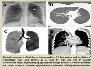 Presentation1, radiological imaging of macleod syndrome. | PPTX