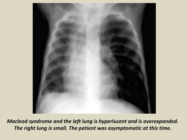 Presentation1, radiological imaging of macleod syndrome. | PPTX