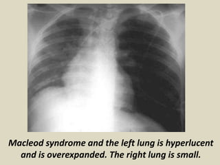 Presentation1, radiological imaging of macleod syndrome. | PPTX
