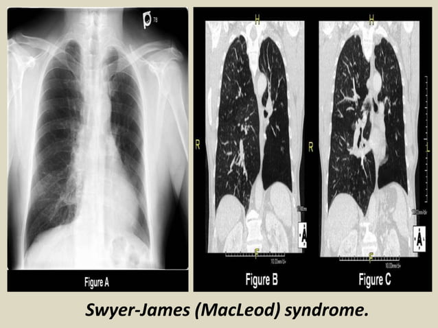Presentation1, radiological imaging of macleod syndrome. | PPTX