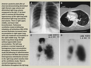 Presentation1, radiological imaging of macleod syndrome. | PPTX