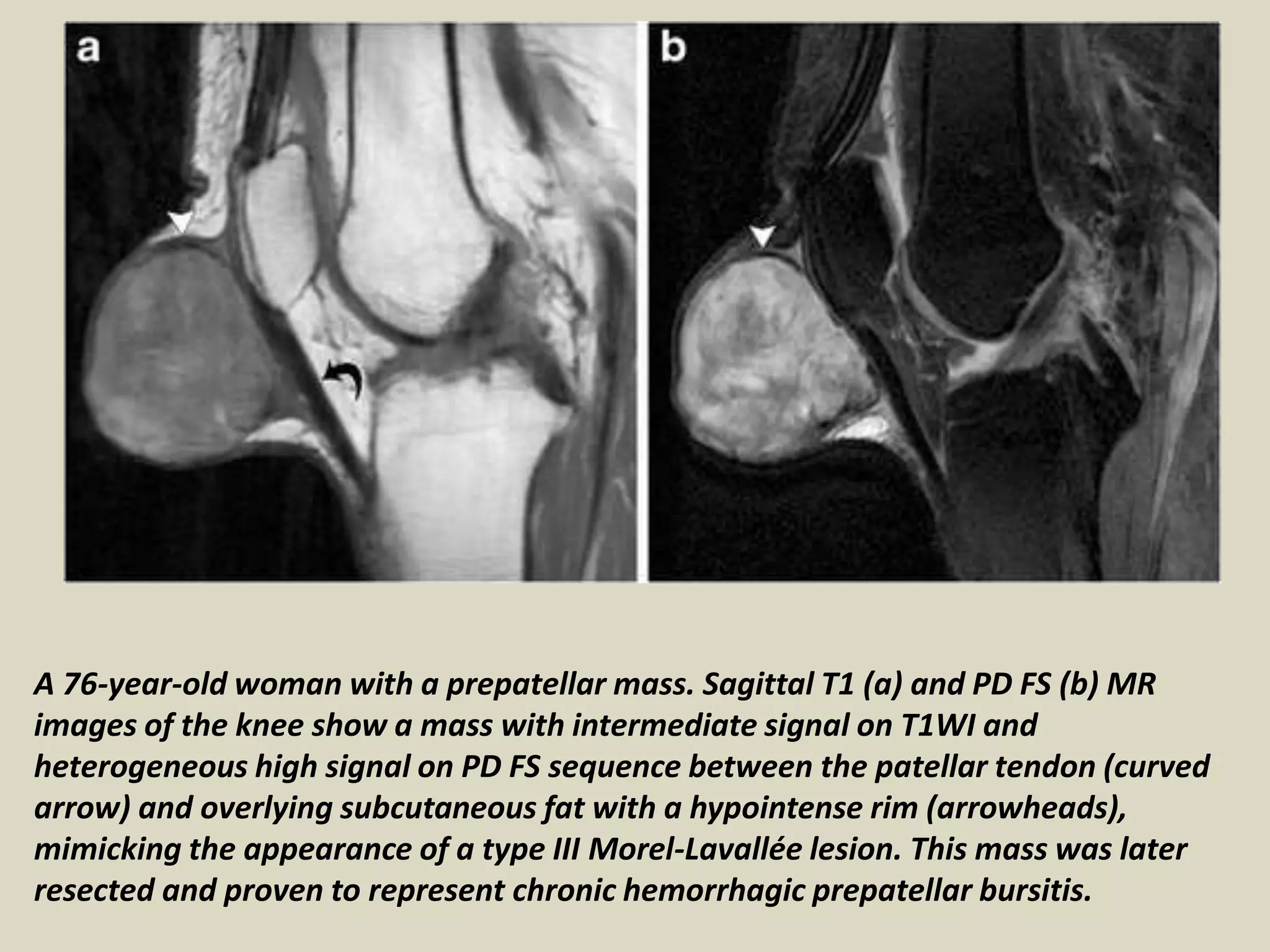 Presentation1, radiological imaging of morel lavallee lesion. | PPTX