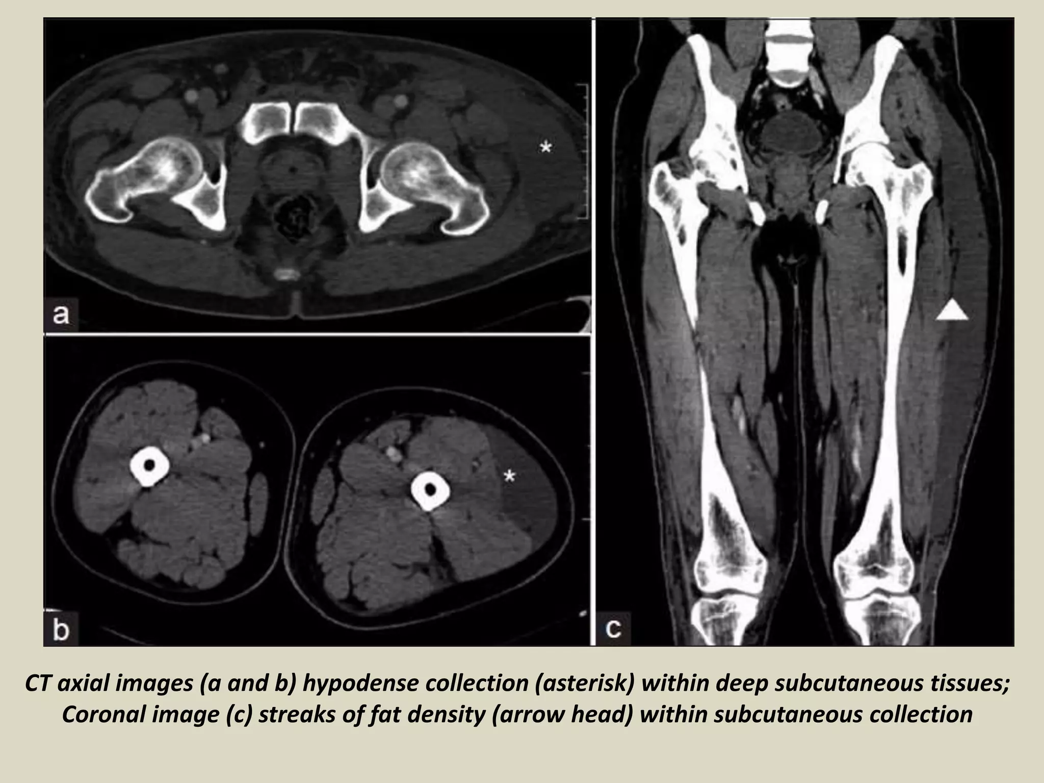 Presentation1, radiological imaging of morel lavallee lesion. | PPTX