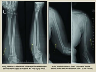 Presentation1, radiological imaging of morel lavallee lesion. | PPTX