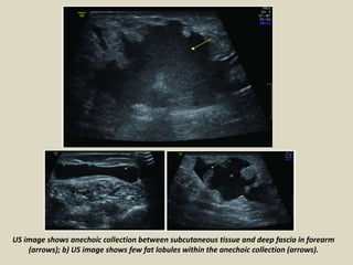 Presentation1, radiological imaging of morel lavallee lesion. | PPTX