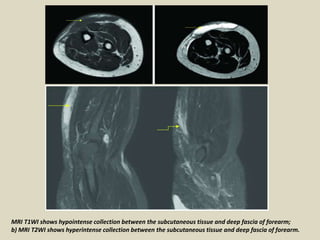 Presentation1, radiological imaging of morel lavallee lesion. | PPTX