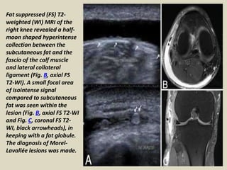 Presentation1, radiological imaging of morel lavallee lesion. | PPTX