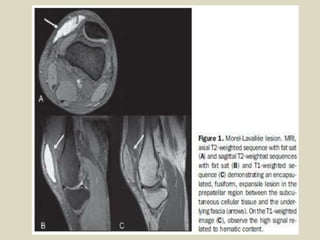 Presentation1, radiological imaging of morel lavallee lesion. | PPTX