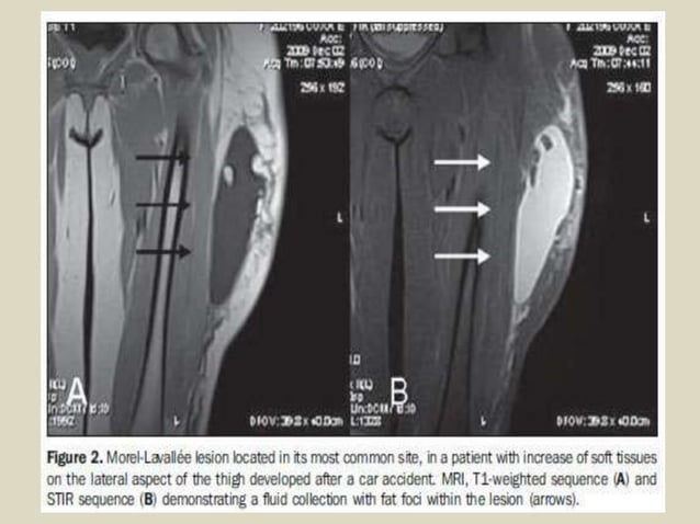 Presentation1, radiological imaging of morel lavallee lesion. | PPT