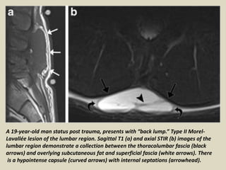 Presentation1, radiological imaging of morel lavallee lesion. | PPTX