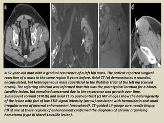 Presentation1, radiological imaging of morel lavallee lesion. | PPTX