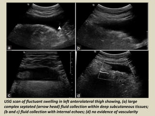 Presentation1, radiological imaging of morel lavallee lesion. | PPTX