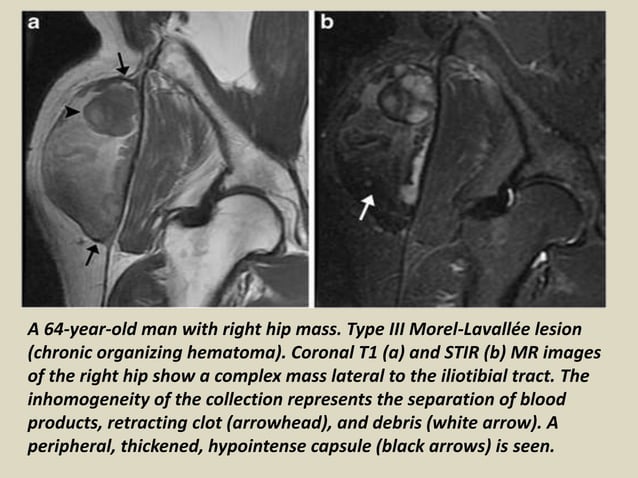 Presentation1, radiological imaging of morel lavallee lesion.