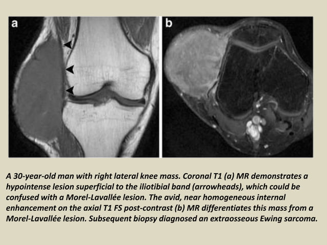 Presentation1, radiological imaging of morel lavallee lesion.
