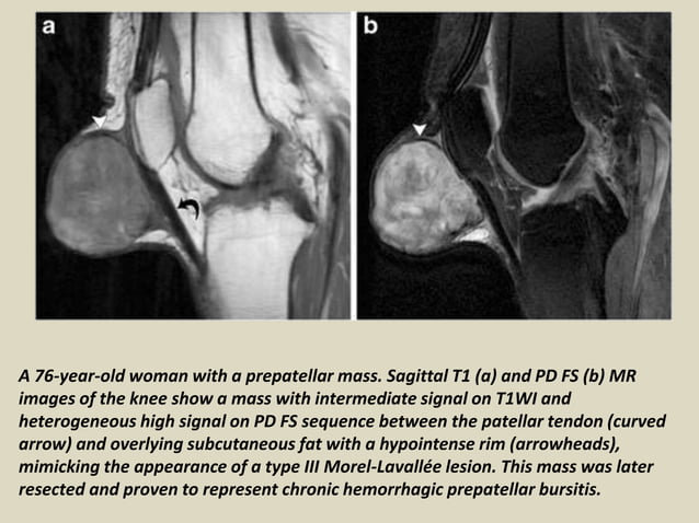 Presentation1, radiological imaging of morel lavallee lesion.